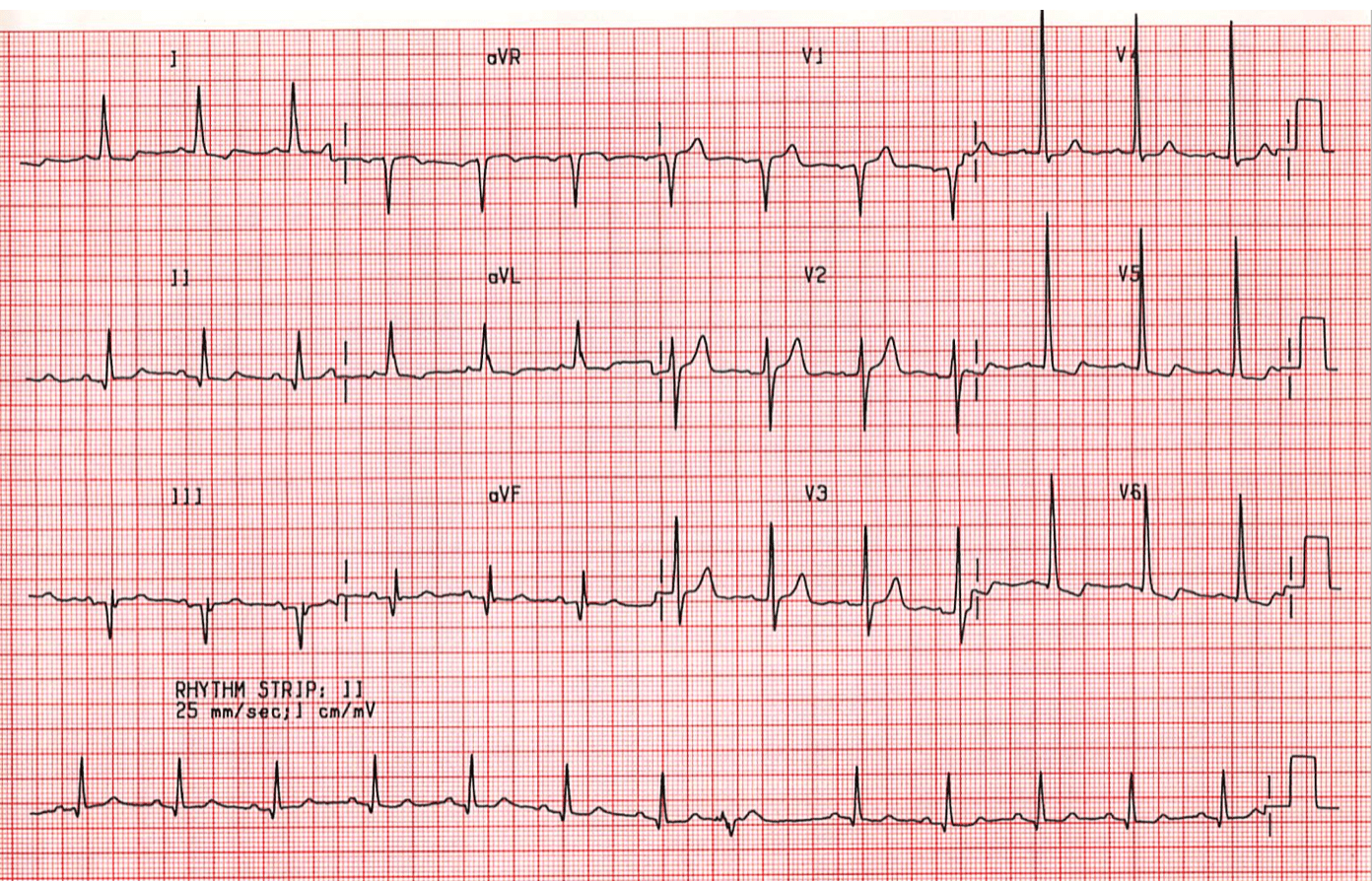 Case A4 Old Inferior Infarction Left Ventricular Hypertrophy St Emlyns Ecg Library