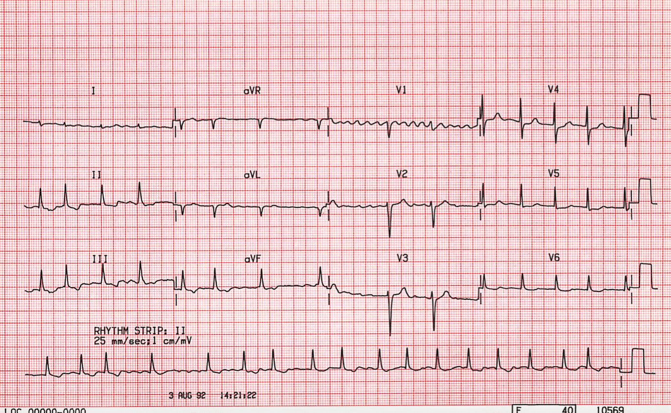 Ventricular Flutter Litfl Ecg Library Diagnosis Left Ventricular