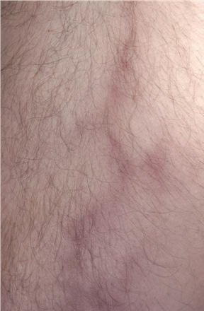 Superficial Venous Thrombosis: watch and wait or anticoagulate?