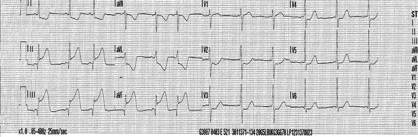 Case A17. Inferoposterior myocardial infarction. St Emlyn's ECG Library ...