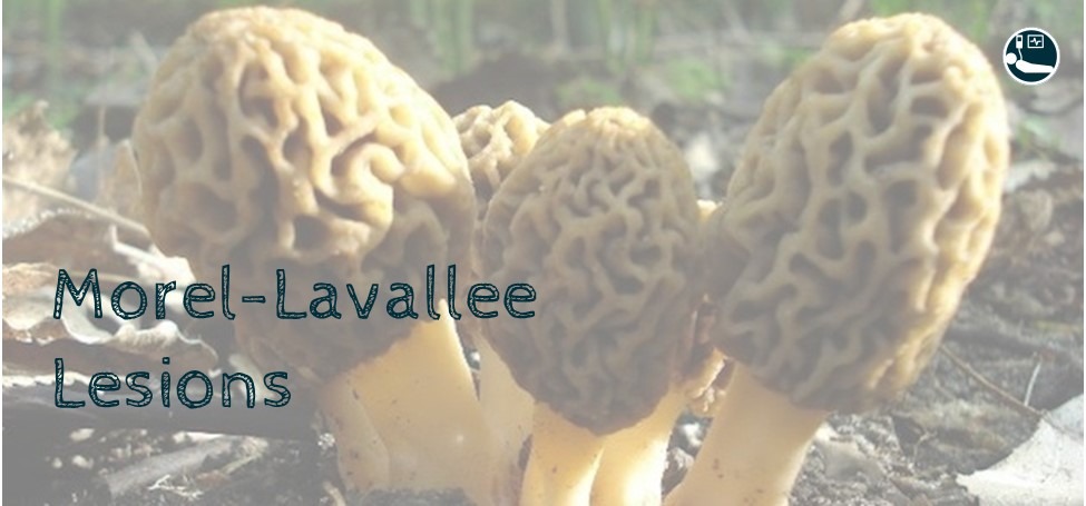 Morel-Lavallée lesions in the ED - St Emlyns