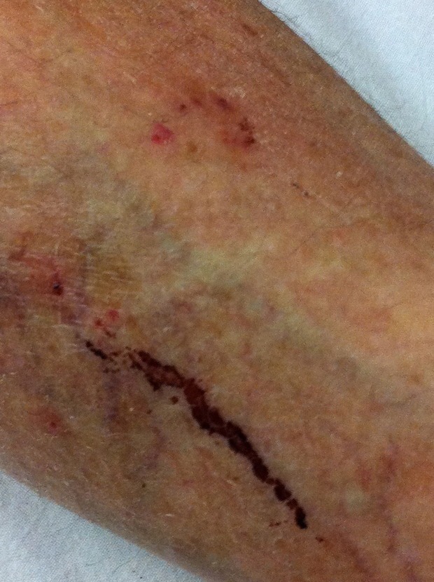 Adder envenomation in the UK St.Emlyn's