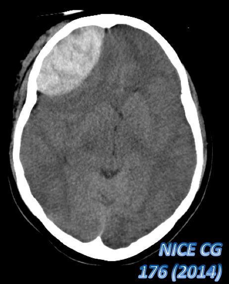 Updated NICE Head Injury Guidelines - Worth a Scan?