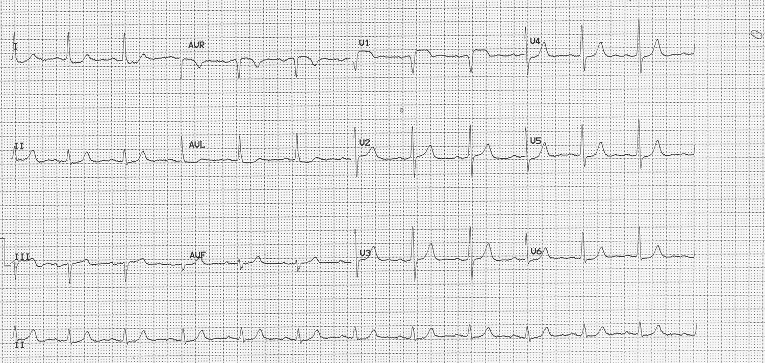 Cardiology Case 04: An unusual ECG • St Emlyn's
