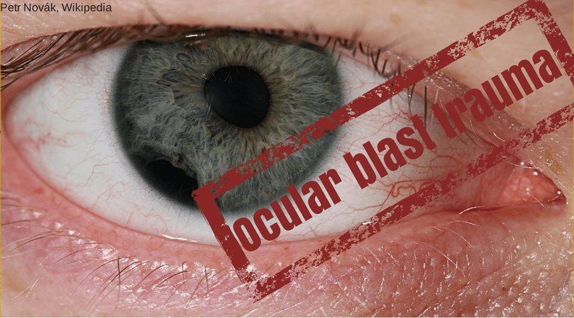 JC: Ocular trauma in blast injuries. St.Emlyn's