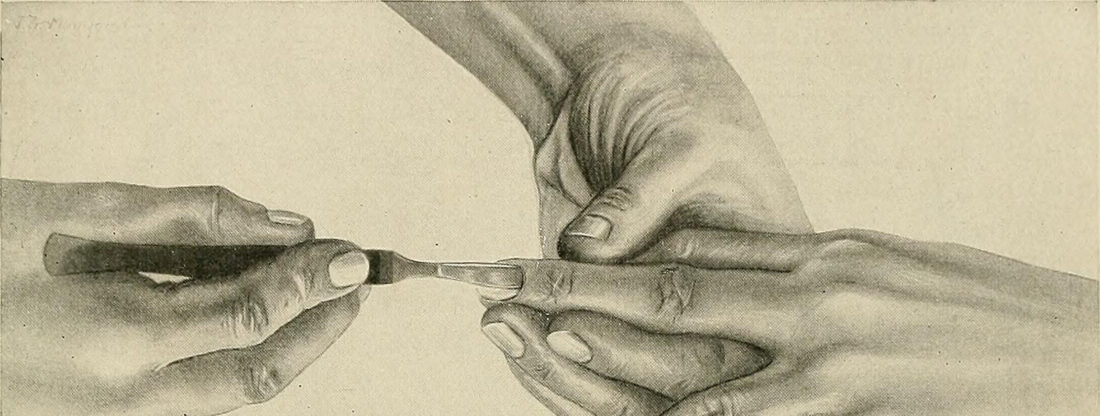 Pointing the Finger – Paronychia in the Emergency Department - St.Emlyn's