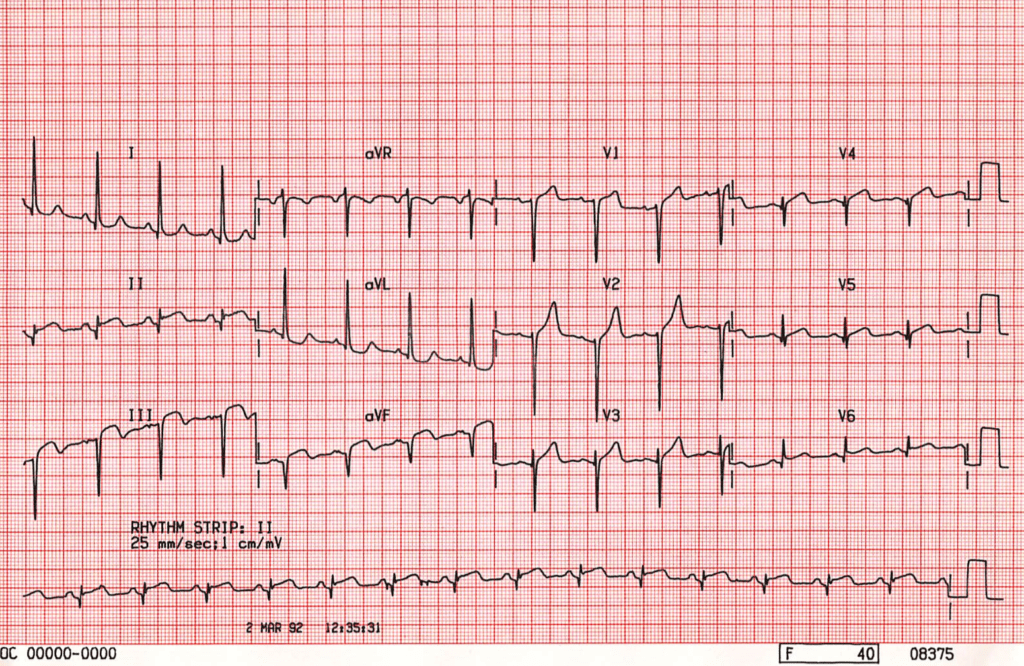 Case A2. Acute Anterolateral infarction. St Emlyn’s ECG Library. - St ...