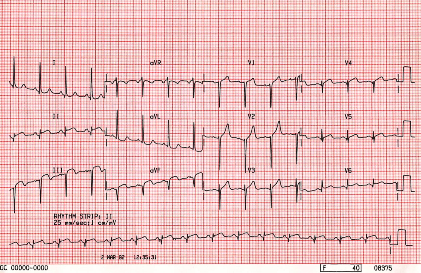 Case A2. Acute Anterolateral infarction. St Emlyn’s ECG Library. - St ...