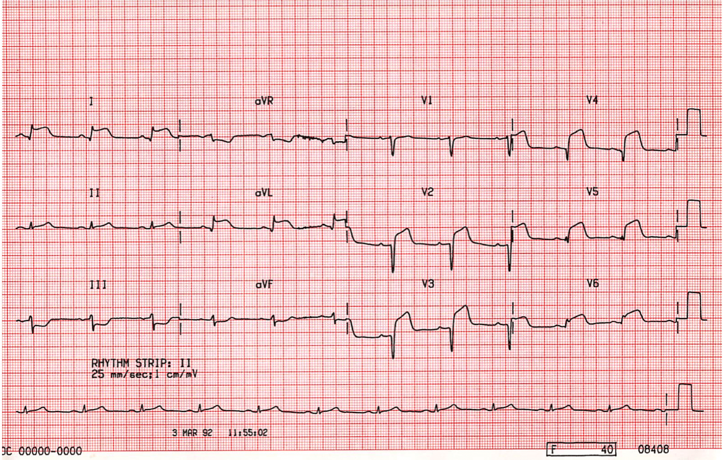 Case A6. Extensive Anterolateral Infarction. St Emlyn's ECG Library