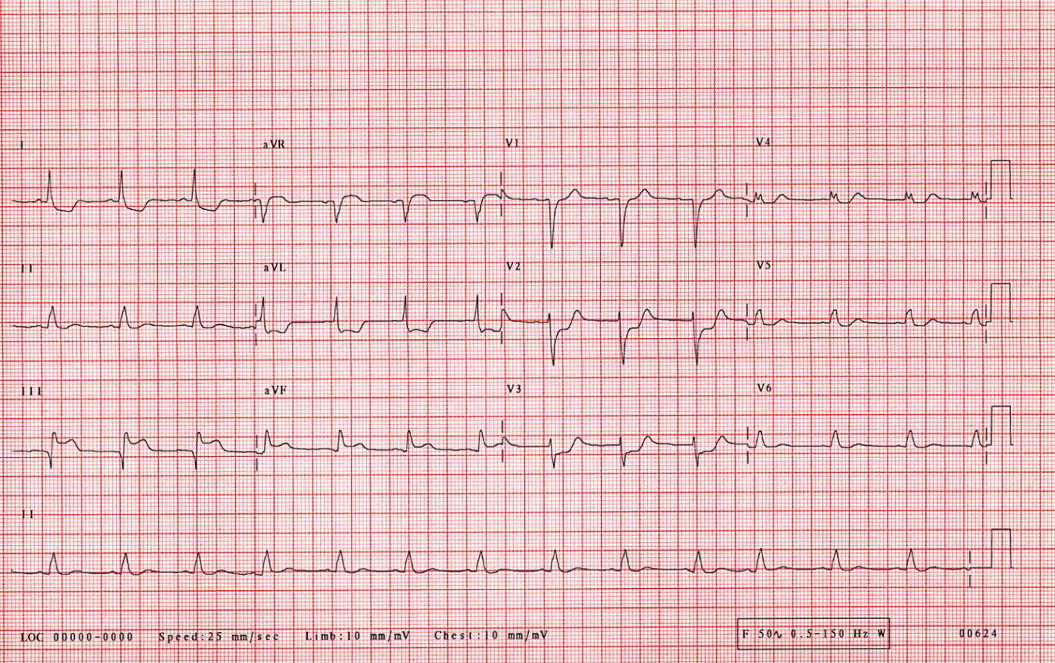 Case A7. Acute Inferior Infarction, Old Anterolateral Infarction. St ...