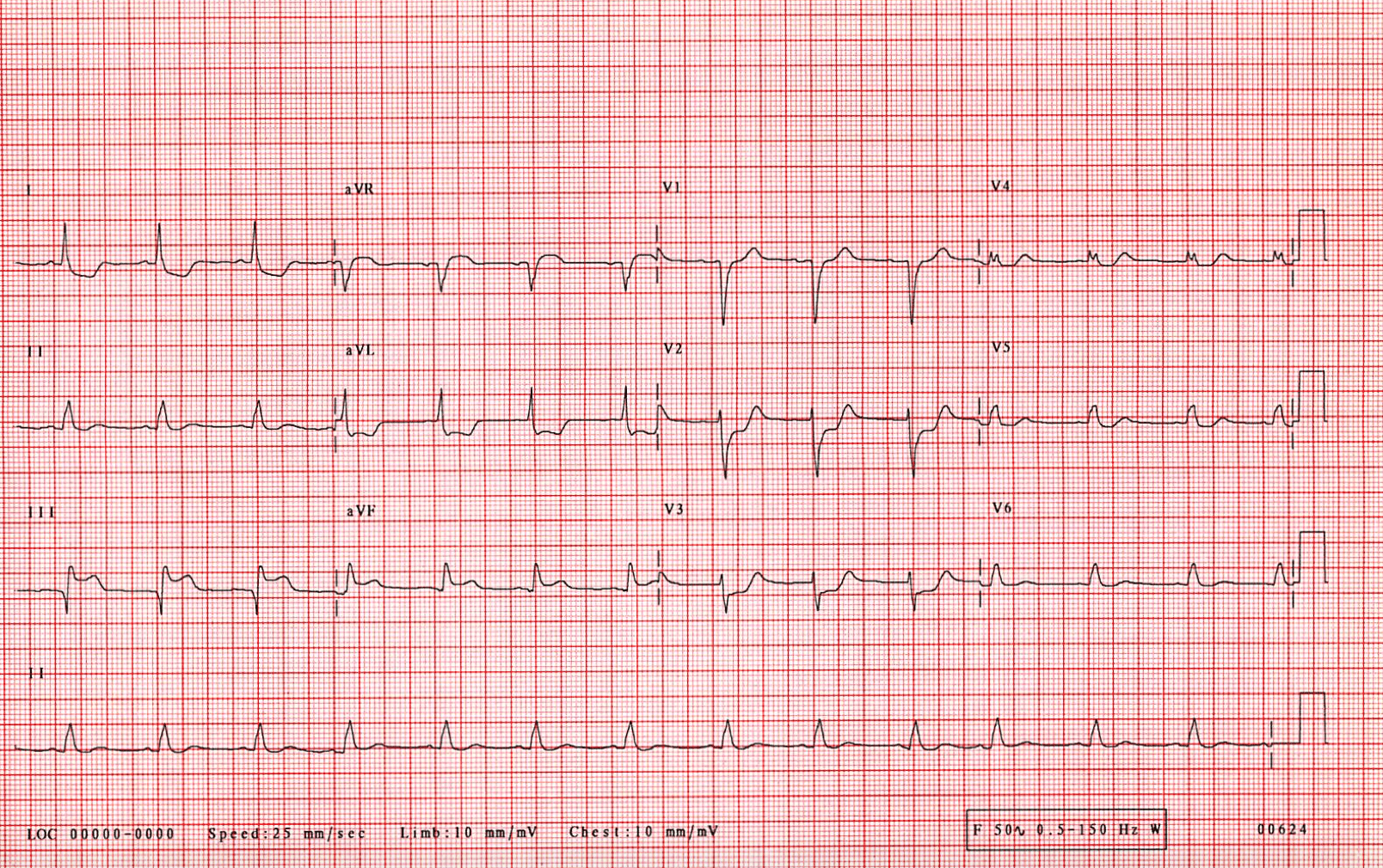 Case A7. Acute Inferior Infarction, Old Anterolateral Infarction. St ...