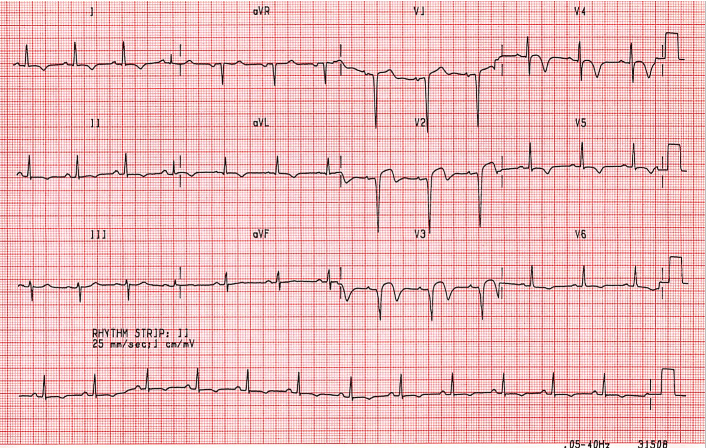 Case A11. Recent Anterior Infarction. St Emlyn's ECG Library