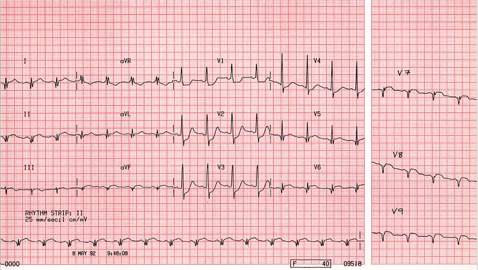 Case A13. Posterior Infarction with Lateral Ischaemia. St Emlyn's ECG ...