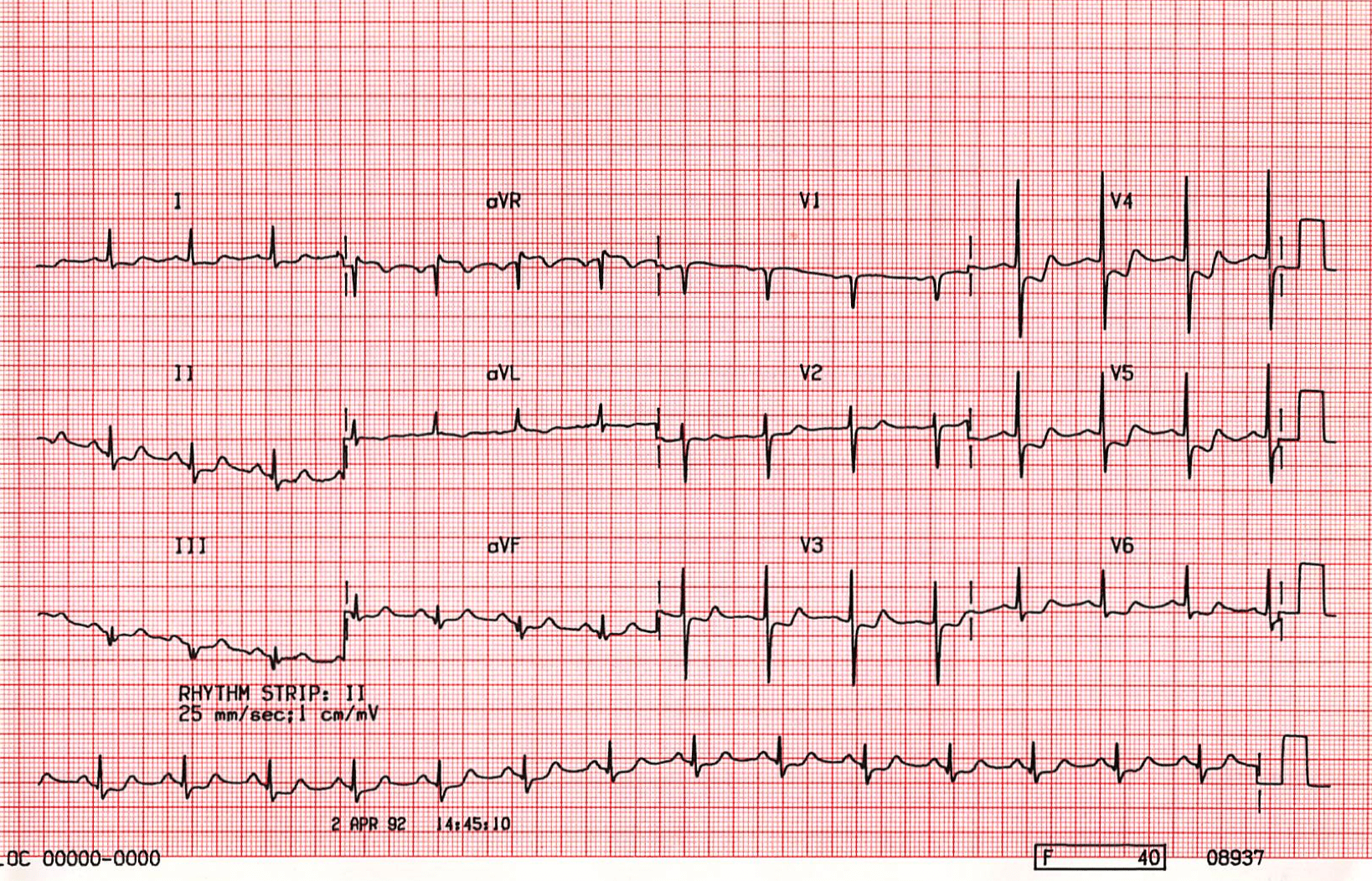 Case A14. Acute Anterolateral Ischaemia. St Emlyn's ECG Library.