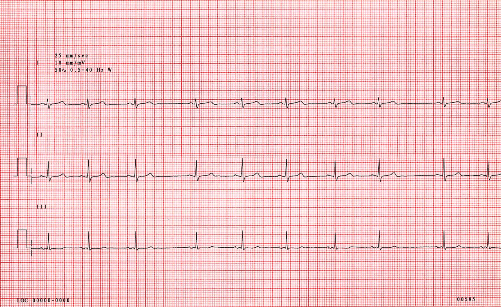 Case B2. Sinus arrythmia. St Emlyn's ECG Library • St Emlyn's