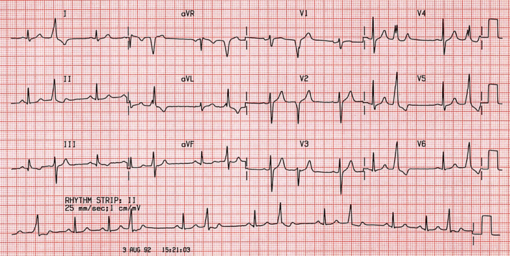 Case B21. Ventricular Premature Beats • ECGs at St Emlyn's
