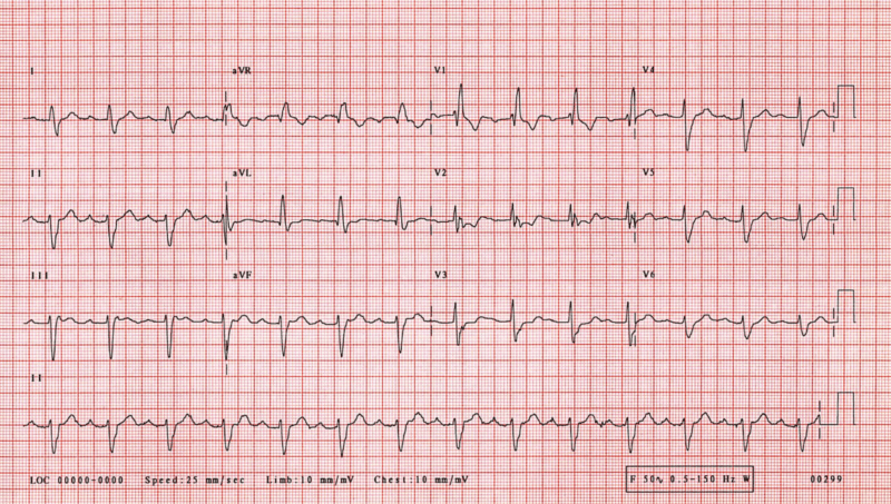 B25. Trifascicular Block • St Emlyn's