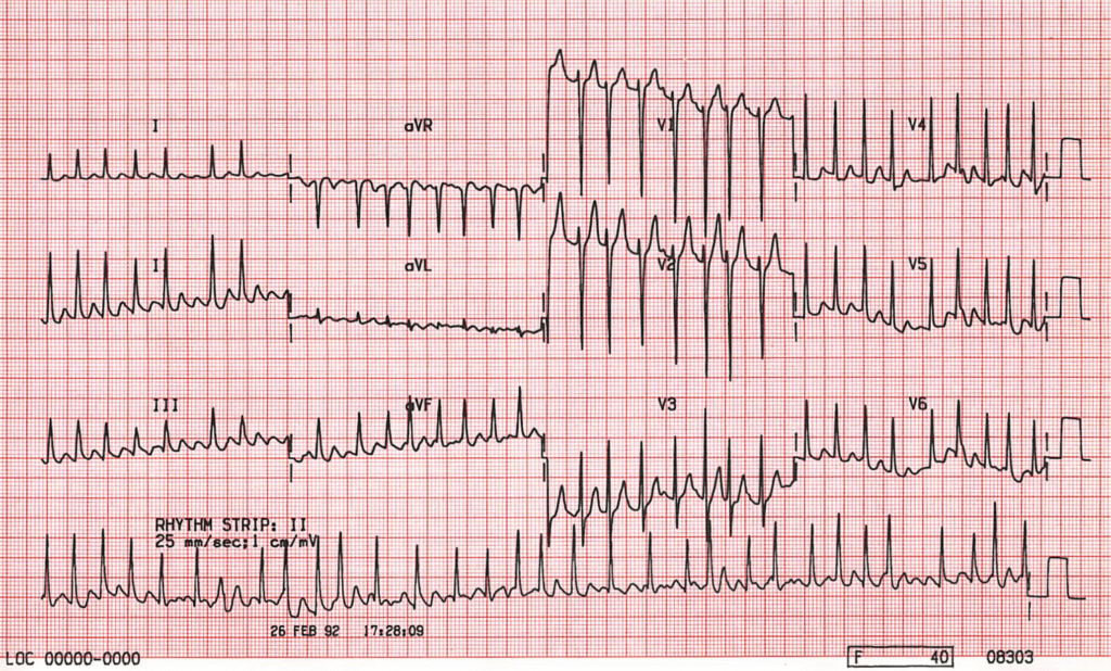 Case B18: Atrial Fibrillation with a Fast Ventricular Rate •St Emlyn's