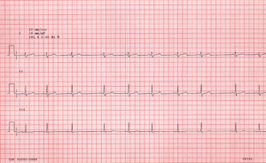 Lesson Plan - Acute Coronary Syndrome • St Emlyn's