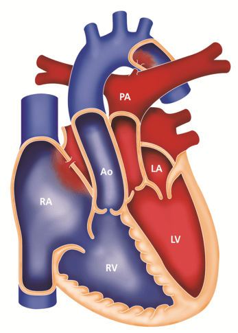 Demystifying Adult Congenital Heart Disease in the ED – The Podcast ...